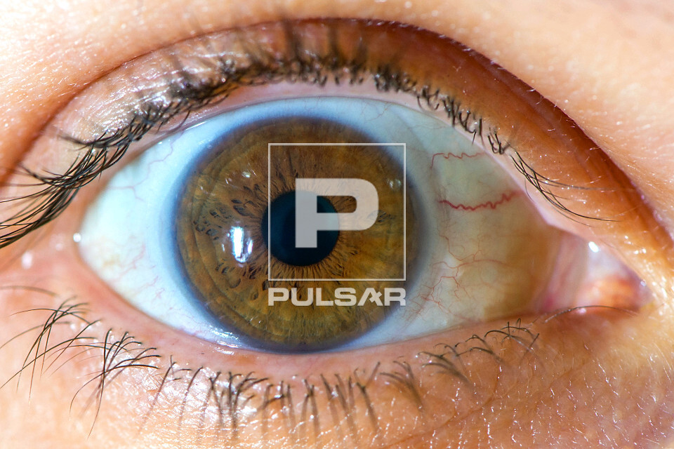 Diafragma Da Iris Do Olho Aniridia