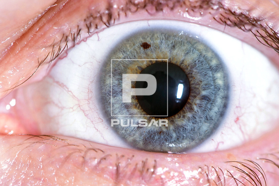 Diafragma Da Iris Do Olho Aniridia